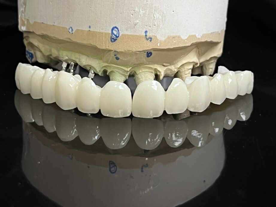 Implant Abutments and Crowns ⋆ Maestro Dental Studio