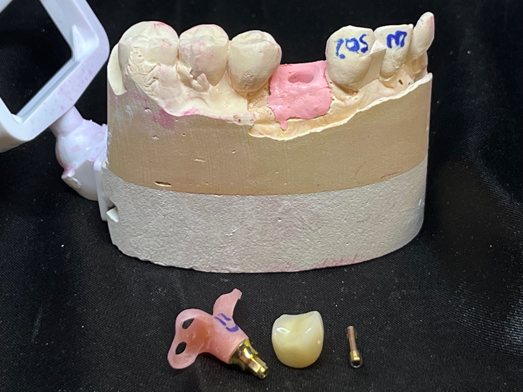 Cement retained crowns ⋆ Maestro Dental Studio